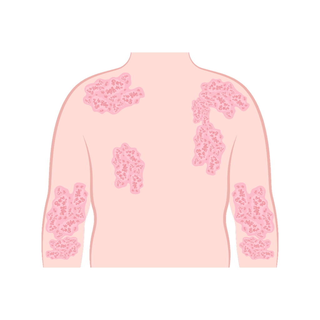 Atopic Dermatitis, Neurodermatitis and the Use of Essential Oils eoASSIST